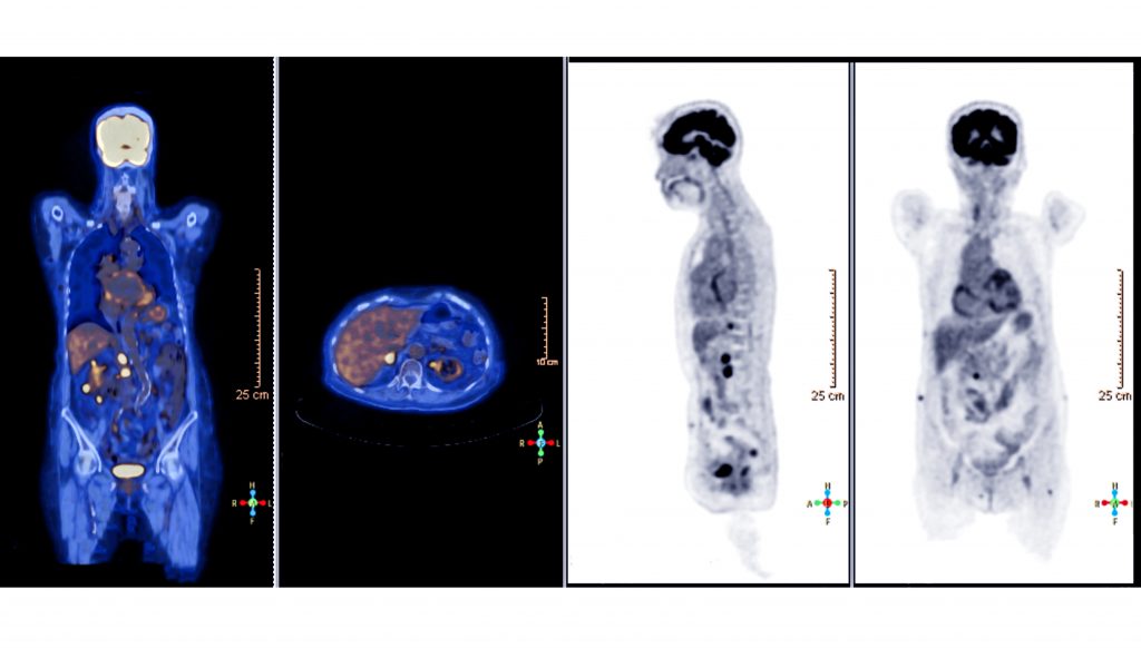 What Should You Expect When Getting a PET Scan? - Hollywood Diagnostics